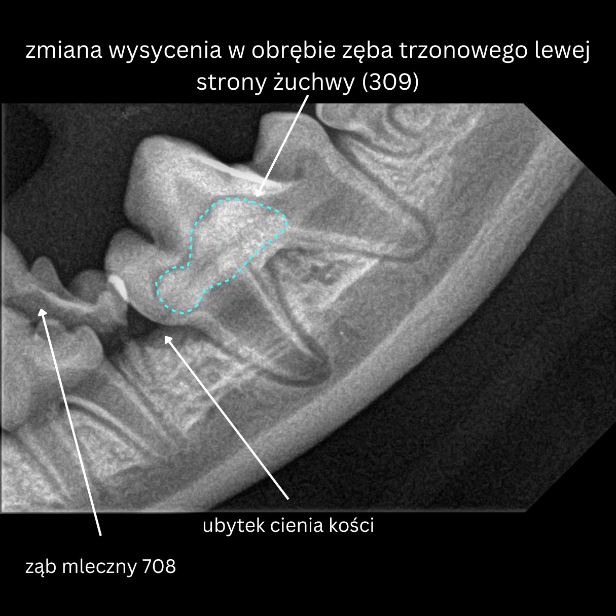 Malformacje łamaczy - Norax Medical - dystrybutor sprzętu medycznego